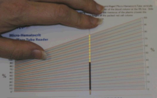 Lab 4: Blood | Longwood University Anatomy and Physiology Lab Manual